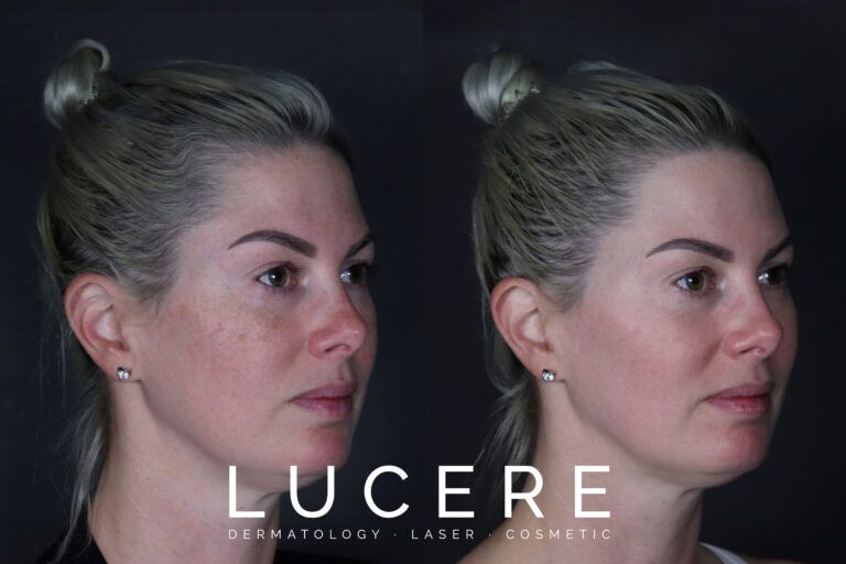 IPL Photofacial Treatment Edmonton - Lucere Dermatology