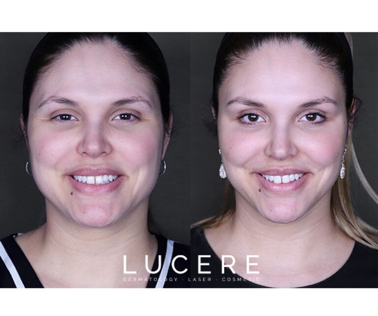Botox for Hooded Eyes - Edmonton - Lucere Dermatology