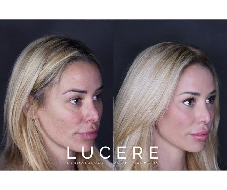 Top Model Cheeks Enhancement - Lucere Dermatology
